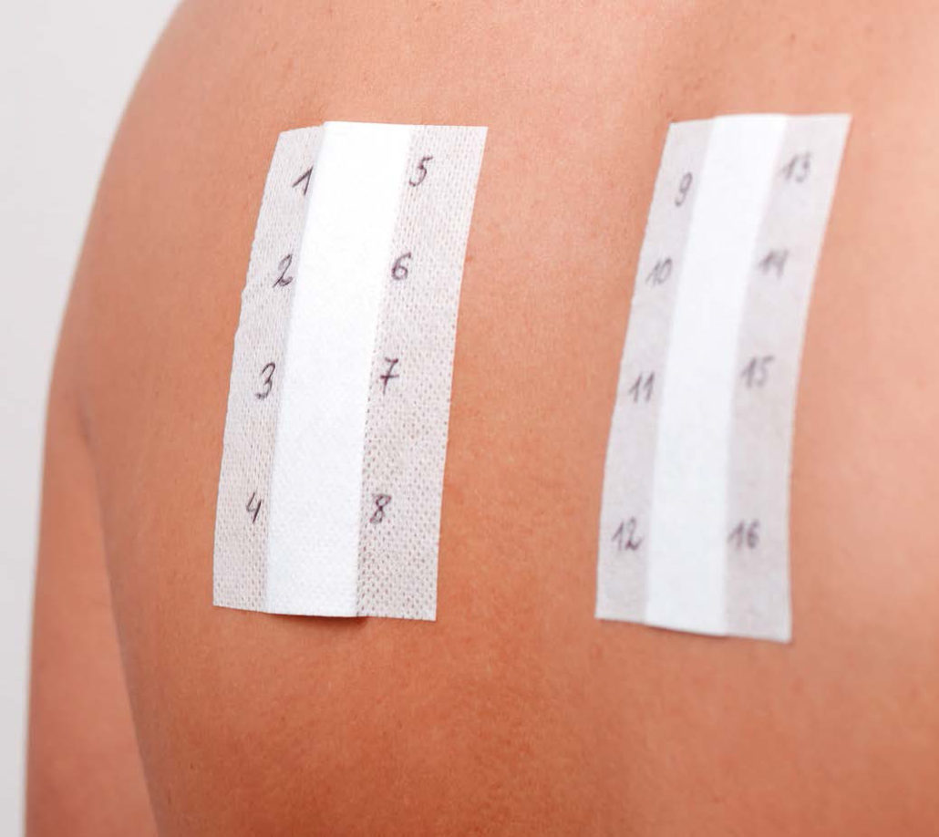 Allergie-Diagnostik - MVZ Benrath